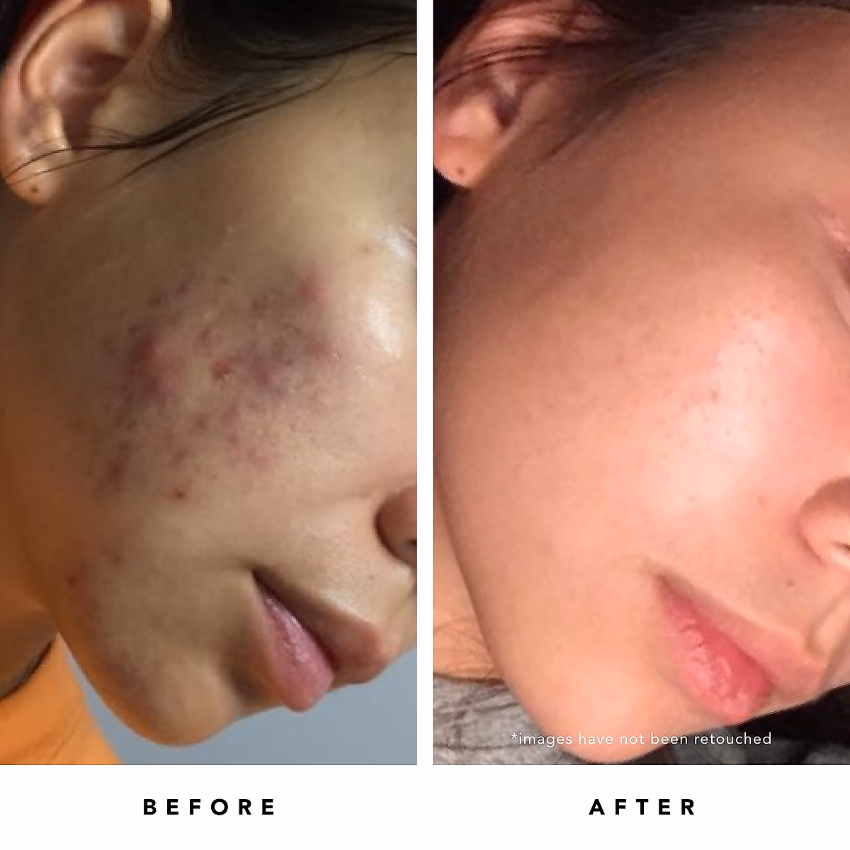 HERBIVORE Blue Tansy BHA & Enzyme Pore Refining Mask - Naturally Clarifies Acne, Blemishes & Redness, Vegan & Cruelty-Free, 60 mL / 2.02 oz