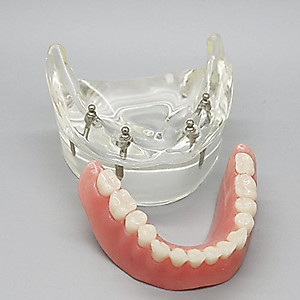 Smile1000 Dental Model Overdenture Inferior 4 Implants Demo for Teaching and Studying