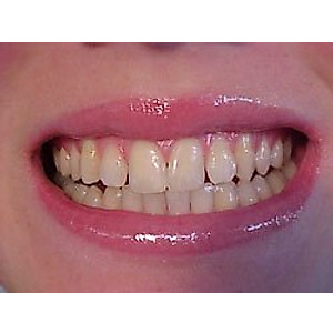 D.I.Y)10 Thermo-molding "BOIL and BITE" Mouth Trays by Instant White Smile Wholesale