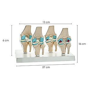 Spancare 4 Stage Osteoarthritis Anatomical Knee Model, Model On Base, with Detailed Study