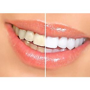 Bright White Smiles - 35% Teeth Whitening Kit - Tooth Gel Whitener and Trays Included - Made in The USA - Ships from Oral Care Dental Laboratory