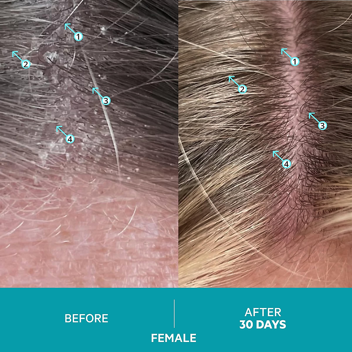 DS Laboratories Dandrene Anti Dandruff Shampoo - Exfoliating Shampoo for Dry Itchy Scalp, Dandruff Scalp Treatment, Seborrheic Dermatitis & Psoriasis