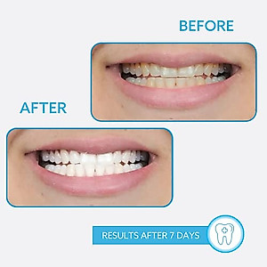 GO SMILE Extreme White Professional Teeth Whitening 7 Day Morning & Night System - Dentist Recommended & Clinically Proven to Whiten in 7 Days with No Sensitivity, 14 Single Use Whitener Applicators