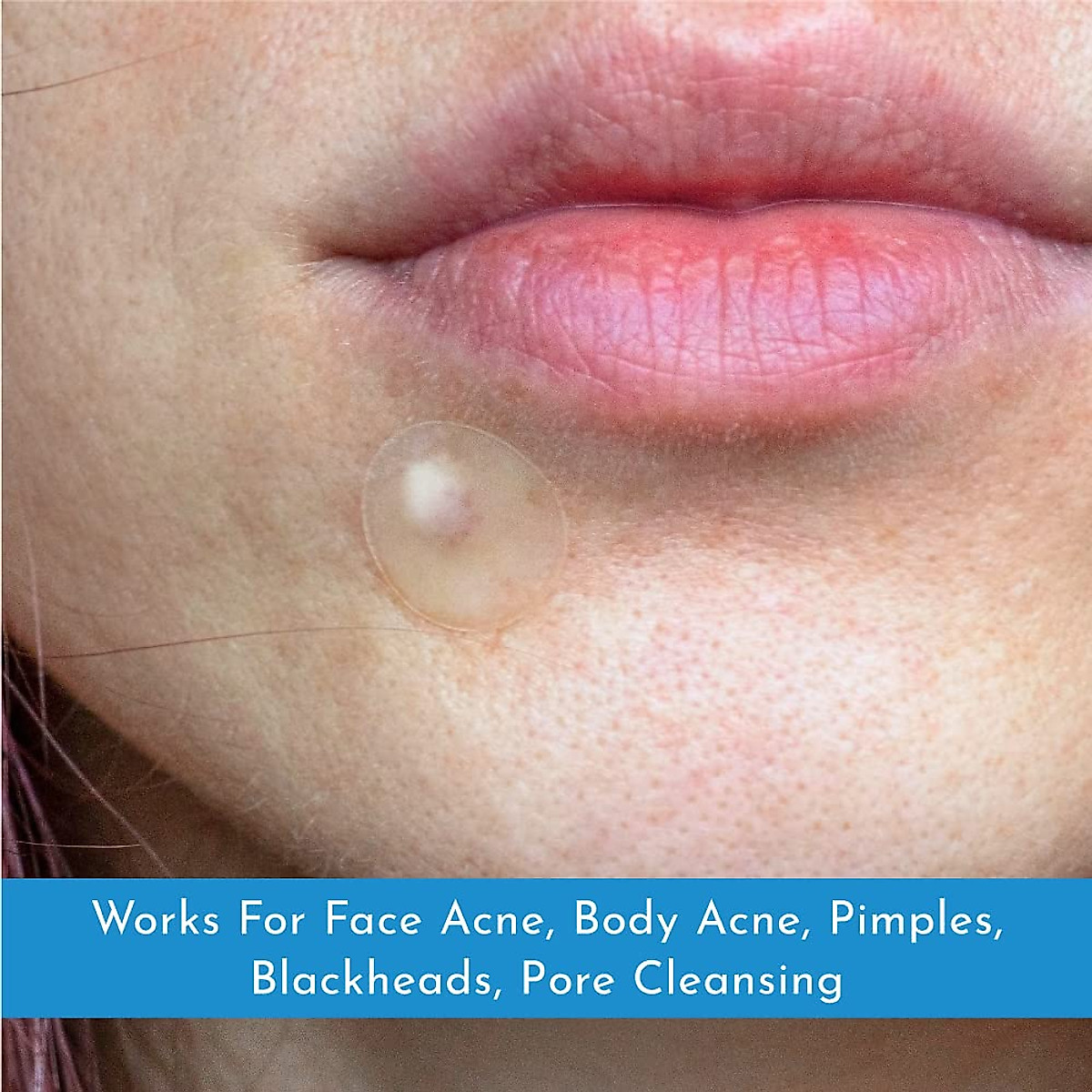 Truly Clear Hydrocolloid Acne Pimple Patches for Face & Body - 72 Count, Ideal for Cystic Acne, Zit & Blemishes - Cruelty Free Acne Dot, Spot Stickers, Acne Cover Patch - Overnight Results