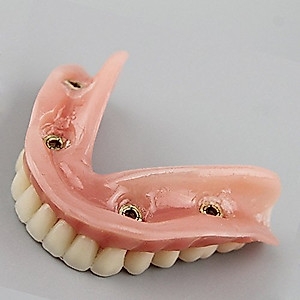 Smile1000 Dental Model Overdenture Inferior 4 Implants Demo for Teaching and Studying