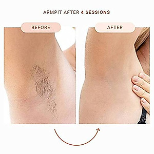 Skinna IPL Laser Hair Removal System | Laser Hair Remover, Permanent Hair Removal for Women & Men | Hair Laser Removal at Home for Face, Arms, Legs, Body, Bikini Line | Painless Hair Removal Laser