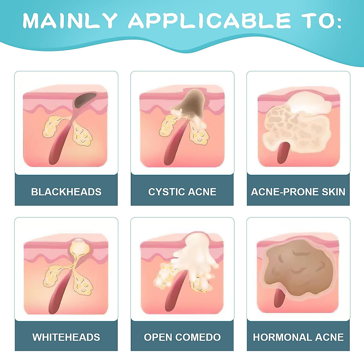 Paradise Emerald Cystic Acne Spot Treatment, Hormonal Acne Treatment for Face，Back and Body, with Salicylic Acid and Tea Tree Oil, Pimple Advanced Acne Cream for Teens & Adults