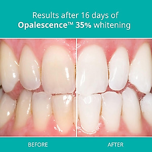 Opalescence 35% Gel Syringes Teeth Whitening - Refill Kit (4 Packs / 8 Count) Carbamide Peroxide. Made by Ultradent, in Cool Mint Flavor. Tooth Whitening Refill Syringes 5197-4