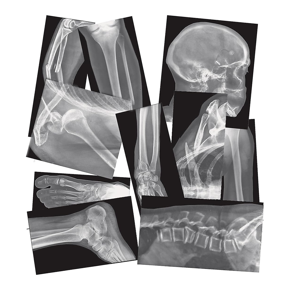 Roylco Broken Bones X-Rays – 15 Realistic Fracture Images for STEM/STEAM Learning, Classroom Anatomy, Health Education, and Labs – Perfect for Teachers, Parents, and Medical Training
