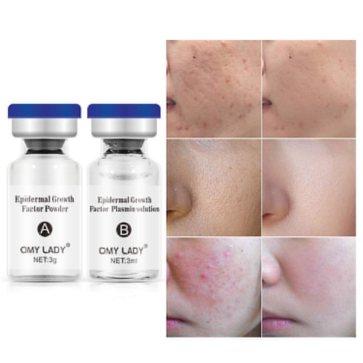 EGF Skin Rejuvenation Serum & Epidermal Growth Factor Powder Kit, Moisturizing Removing Wrinkles, Fine Lines and Pigmentation, Acne Scars Treatment Facial Repairing Serum