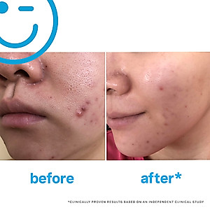 EradiKate 3% Sulfur Daily Foaming Cleanser Acne Treatment – Clinically Formulated Medicated Face Wash Balances Skin and Cleans Pores, 4 Fl Oz