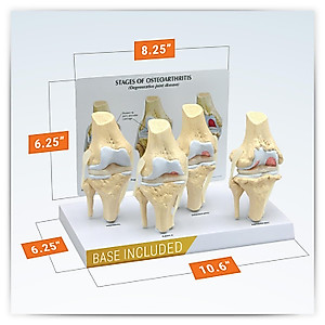 GPI Anatomicals Knee Joint Model Set | Human Body Anatomy Replica Set of 4-Stage Osteoarthritis Knee Joint for Doctors Office Educational Tool