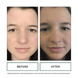 Replenix Gly-Sal 5-2 Deep Pore Facial Cleanser, Medical-Grade 5% Glycolic & 2% Salicylic Acid Oil-Free Face Wash for Acne-Prone Skin (6.7 fl. oz)