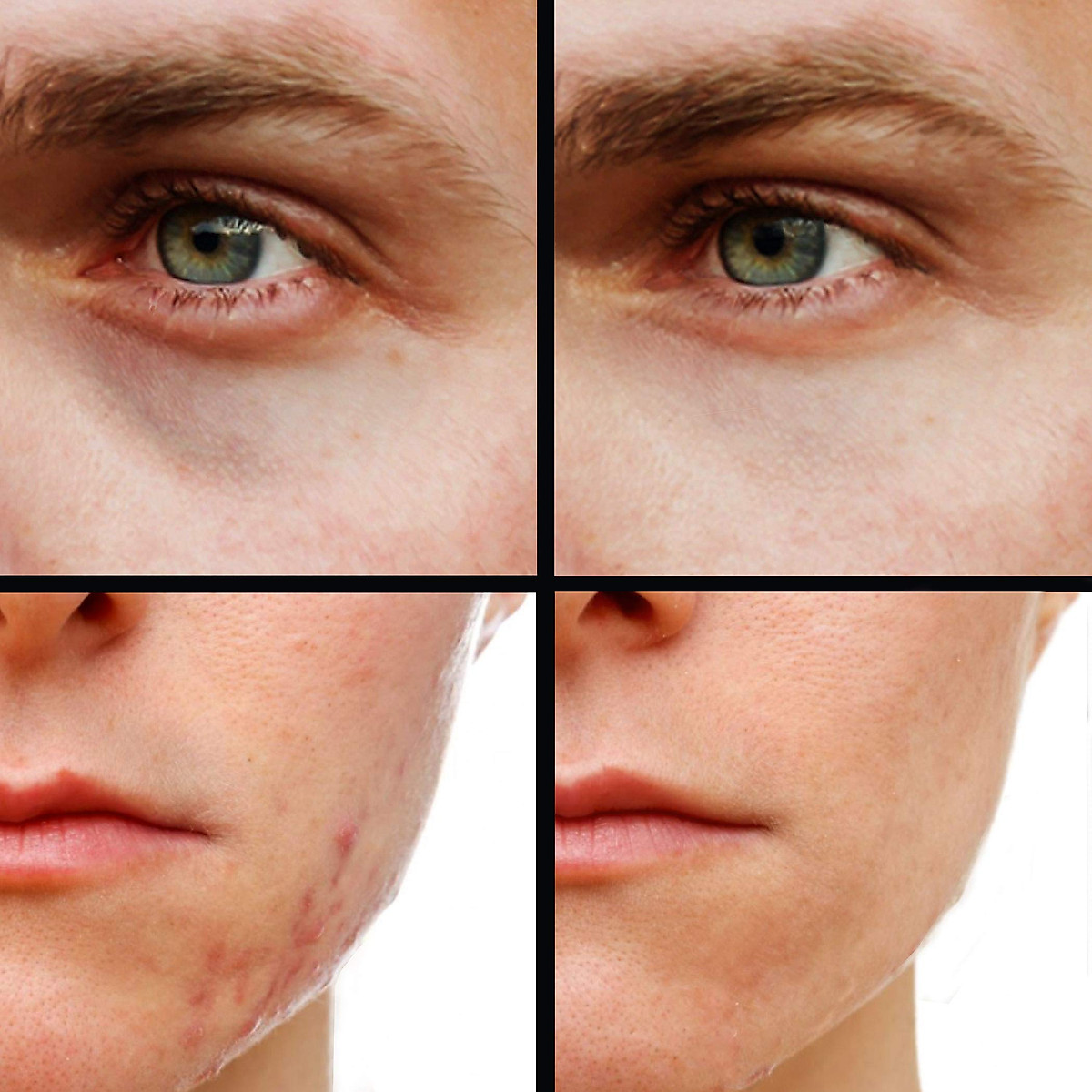 KODE Mens Concealer (Shade 3 of 6) Dark Circle Under Eye Cream Corrector, Multi-Use, Pimples, Scars, Rashes