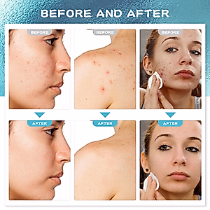 Paradise Emerald Cystic Acne Spot Treatment, Hormonal Acne Treatment for Face，Back and Body, with Salicylic Acid and Tea Tree Oil, Pimple Advanced Acne Cream for Teens & Adults