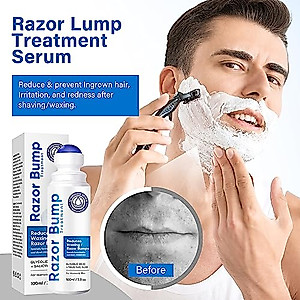 Razor Bump Treatment - Ingrown Hair Treatment for Razor Bumps, After Shave Treatment for Face, Neck, Bikini Area, Legs, With Salicylic Acid, Glycolic Acid
