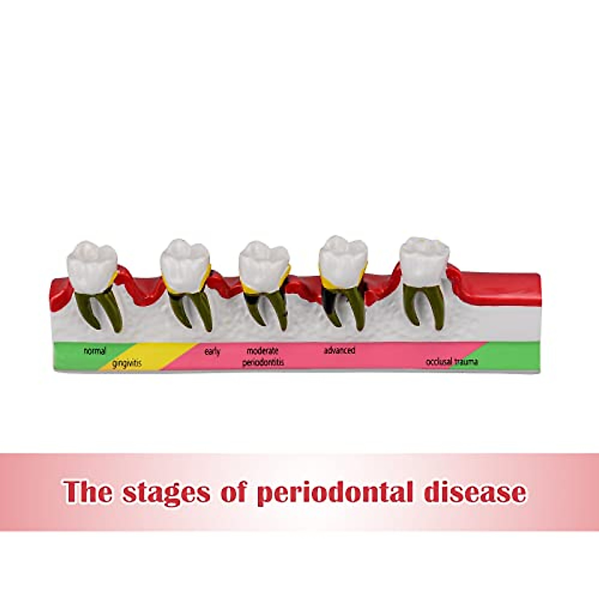 Ultrassist Dental Periodontal Disease Model, Dental Teeth Model for Dental Tooth Anatomy Study, Doctor-Patient and Oral Care Education