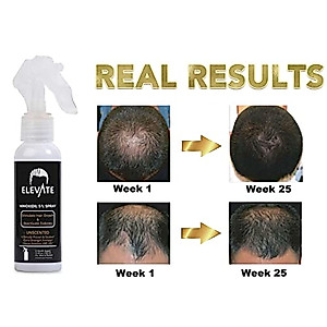 ELEVATE 5% Minoxidil Hair Growth Spray - Extra Strength Professional Treatment for Hair Loss and Hair Regrowth - Stimulate Hair Follicles for Men & Women - 1 to 2 Month Supply 100ml