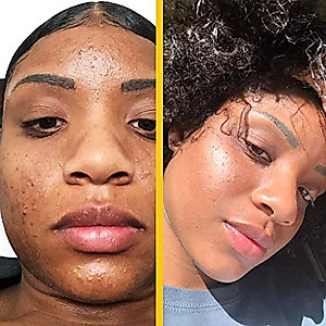 Pure Pigmentation Cream, Derm by Erica for Melasma