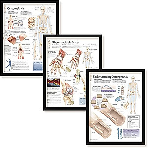 Set of 3 Framed Medical Posters Osteoarthritis Rheumatoid Arthritis Understanding Osteoporosis 22"x28" Wall Diagrams Educational Informational Doctors Office Rheumatology Charts