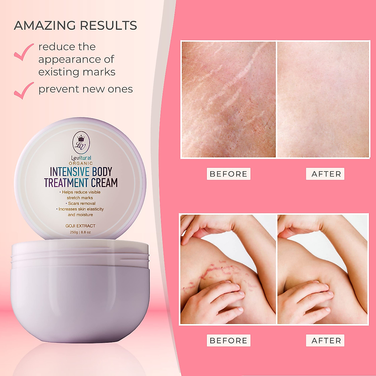 Levitural Stretch Mark & Scar Removal Cream for Pregnancy, Postpartum (2-in-1) - Maternity Skin Care Moisturizer Stretch Mark Prevention with Antioxidant Goji Extract - EXTRA LARGE Volume (8.8 Oz)