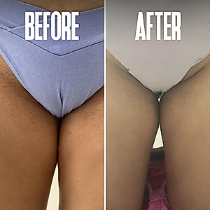 Prevent Ingrown Hairs and Razor Bumps with BHA & AHA Pads - Ingrown Hair Serum for Razor Burns - PFB Razor Bump Stopper Topicals Skin Care, Ingrown Hair Treatment for Bikini Area and Razor Bumps