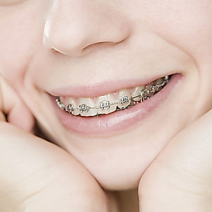 Sihuuu 100 PCS Orthodontic Elastic Rubber Bands, 1/4 Inch Free Elastic Placer, Orthodontic Elastics Small Rubber bands for Braces, Hair Braids, Dreadlocks, Fix Tooth Gap