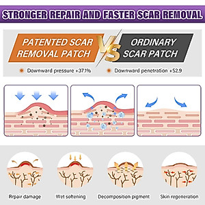 Silicone Scar Sheets,Silicone Scar Tape,Scar Tape For Surgical Scars,Silicone Scar Removal Strips For Surgical,C-Section,Tummy Tuck,Keloid Scars(1.6"X 59" Roll-1.5M) Keloid Bump Removal