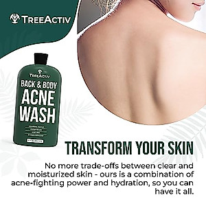TreeActiv Acne Exfoliating Body Wash, 8oz, Foam Cleanser for All Skin Types, Sulfur, Aloe Vera, Jojoba Beads