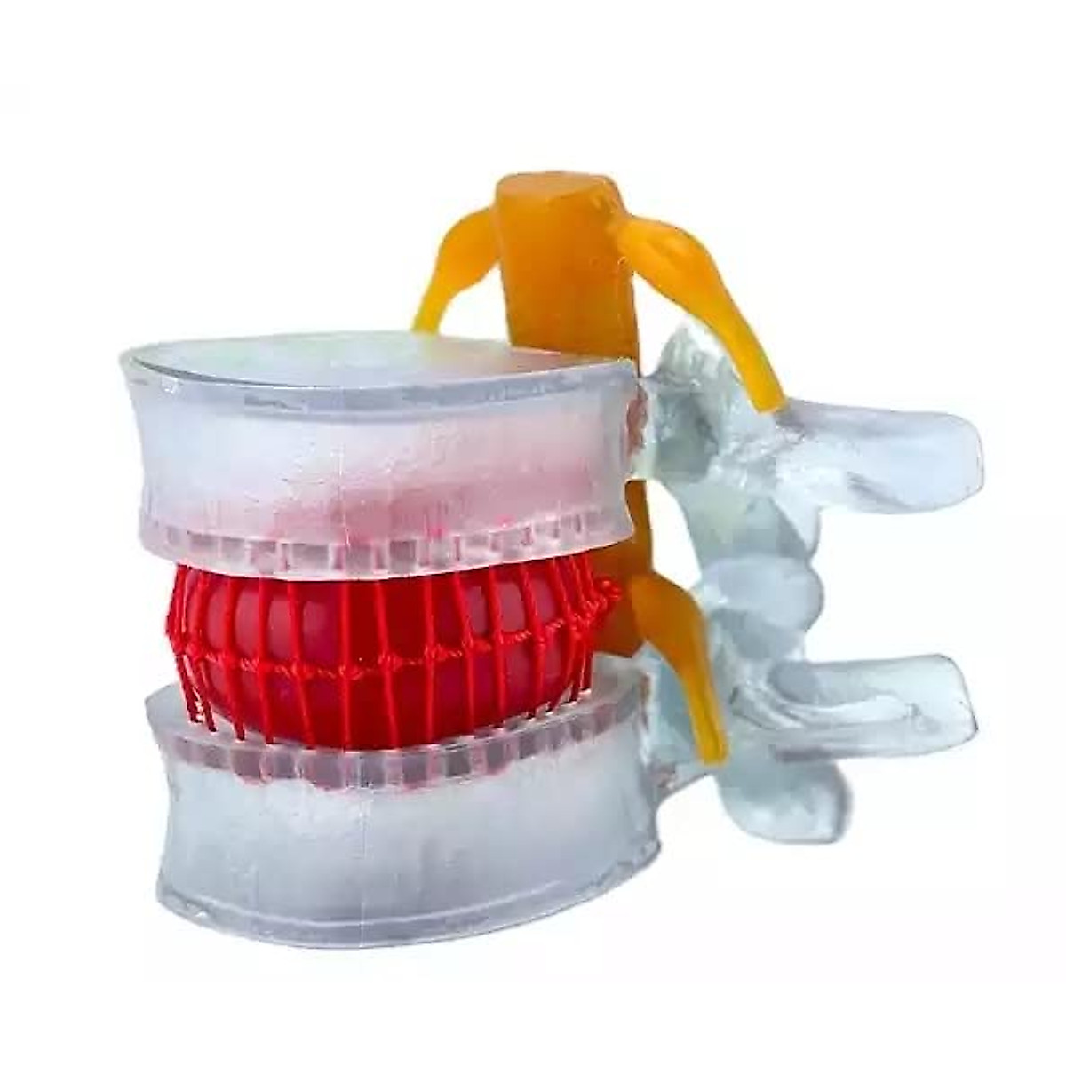DenFactory Human 1.5 Times Life-Size Transparent Lumbar Disc Herniation Spine Model for Teaching and Learning