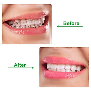 20 Pieces Aligner Tray Seaters for Aligner Trays Chompers Orthodontic Trays(Green)