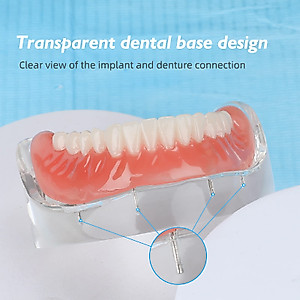 faruijie Overdenture Model - Implant Overdenture Model Lower Denture Model with Four Implants Dental Model Overdenture for Teaching and Studying