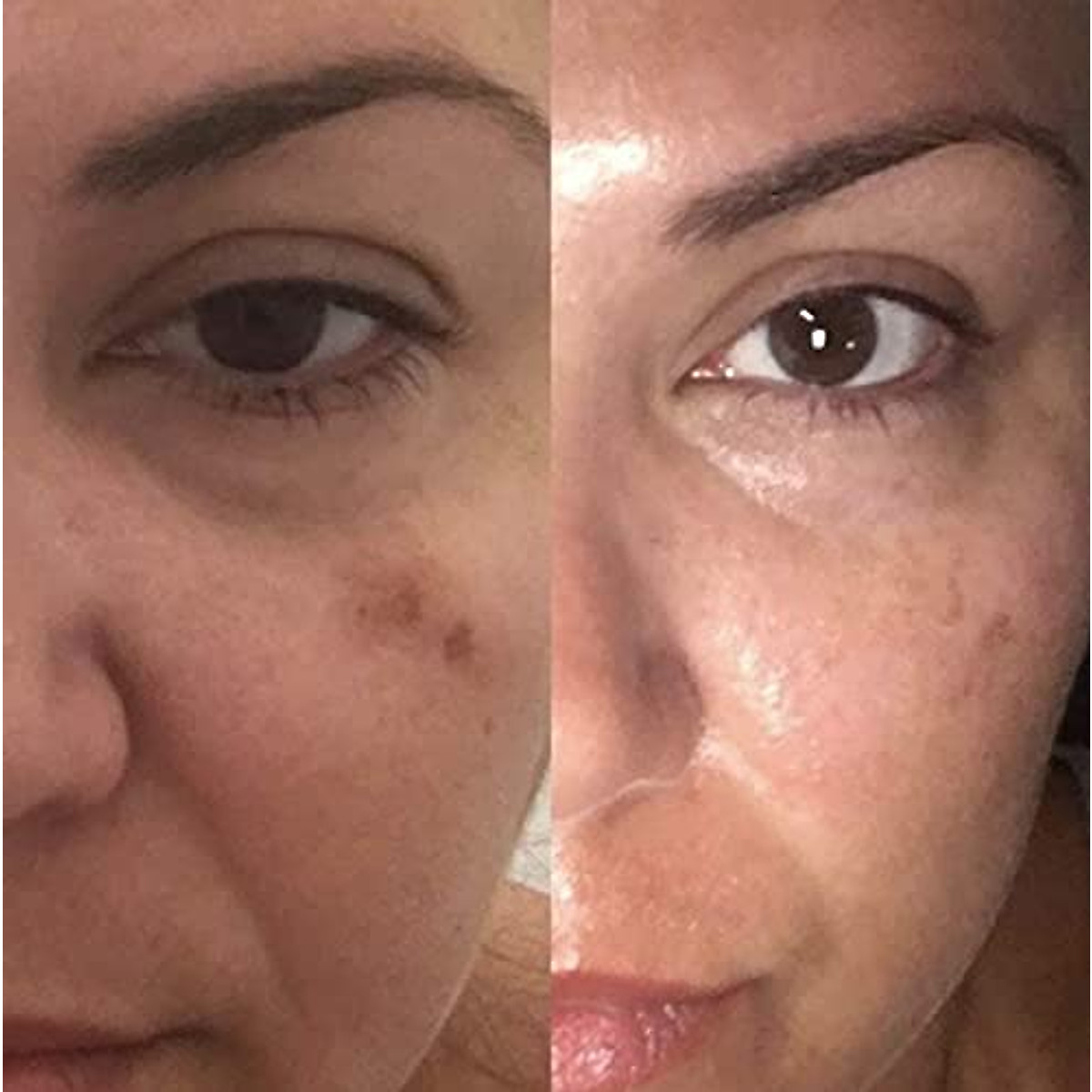 Dark Spot Corrector, Dark Spot Remover for Face, Melasma and Hyperpigmentation Treatment, Dark Spot Serum, Age Spot Remover, with Tyrostat, Kojic Acid, Alpha Arbutin, Mulberry Extract, Lactic Acid 1oz