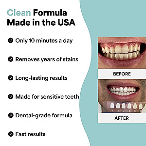 Sol Professional Teeth Whitening Kit with LED Light, Non-Sensitive & Fast Tooth Whitener, All Natural, Vegan, 3 Carbamide Peroxide Whitening Gel & 1 Remineralizing Pen, Shade Guide & Case, 50 Sessions