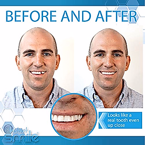Instant Smile Complete Your Smile Temporary Tooth Replacement Kit - Replace a Missing Tooth in Minutes - Patented