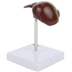 Axis Scientific Anatomy Model of Diseased Liver | Model is 1/3 Life-Size and Divides in 2 Parts | Shows 6 Liver Diseases and Abnormalities | Comes on a White Base