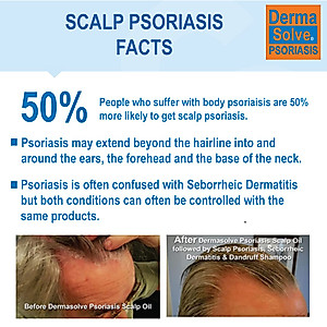 Dermasolve Scalp Psoriasis Medicated Shampoo & Conditioner - Naturally Heals Dandruff Seborrheic Dermatitis Itchy Flakey Inflamed Skin & Provides Soothing Moisturizing Relief - 8 oz bottles (2 Pack)