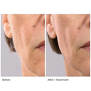 Michael Todd Beauty - Sonicsmooth Replacement Kit for At-Home Dermaplaning - 7 Replacement Safety Edges Only