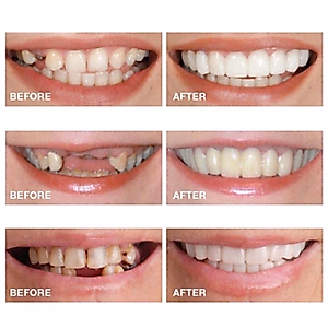 CHNLML Fake Teeth, Cosmetic Denture Veneers for Upper and Lower Jaw, Dental Veneers for Temporary Teeth Restoration, Nature and Comfortable, Protect Your Teeth - 2 Pcs