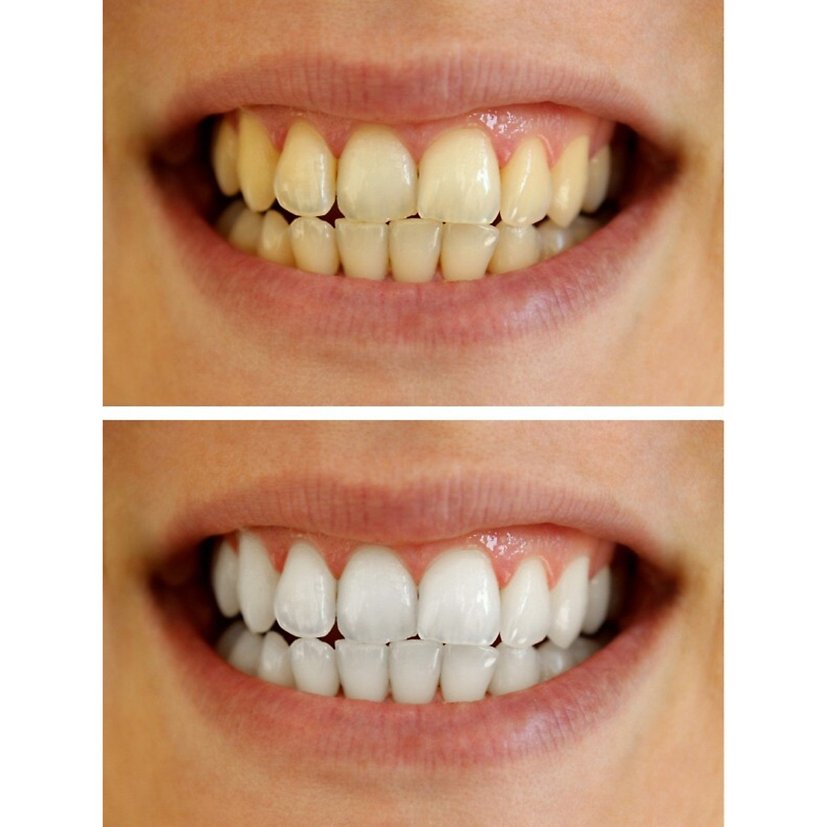 Teeth Whitening Kit 35% Carbamide Peroxide, 10 Tooth Bleaching Gel Syringe Dispensers, 2 Thermo Forming Dental Trays with Storage Case