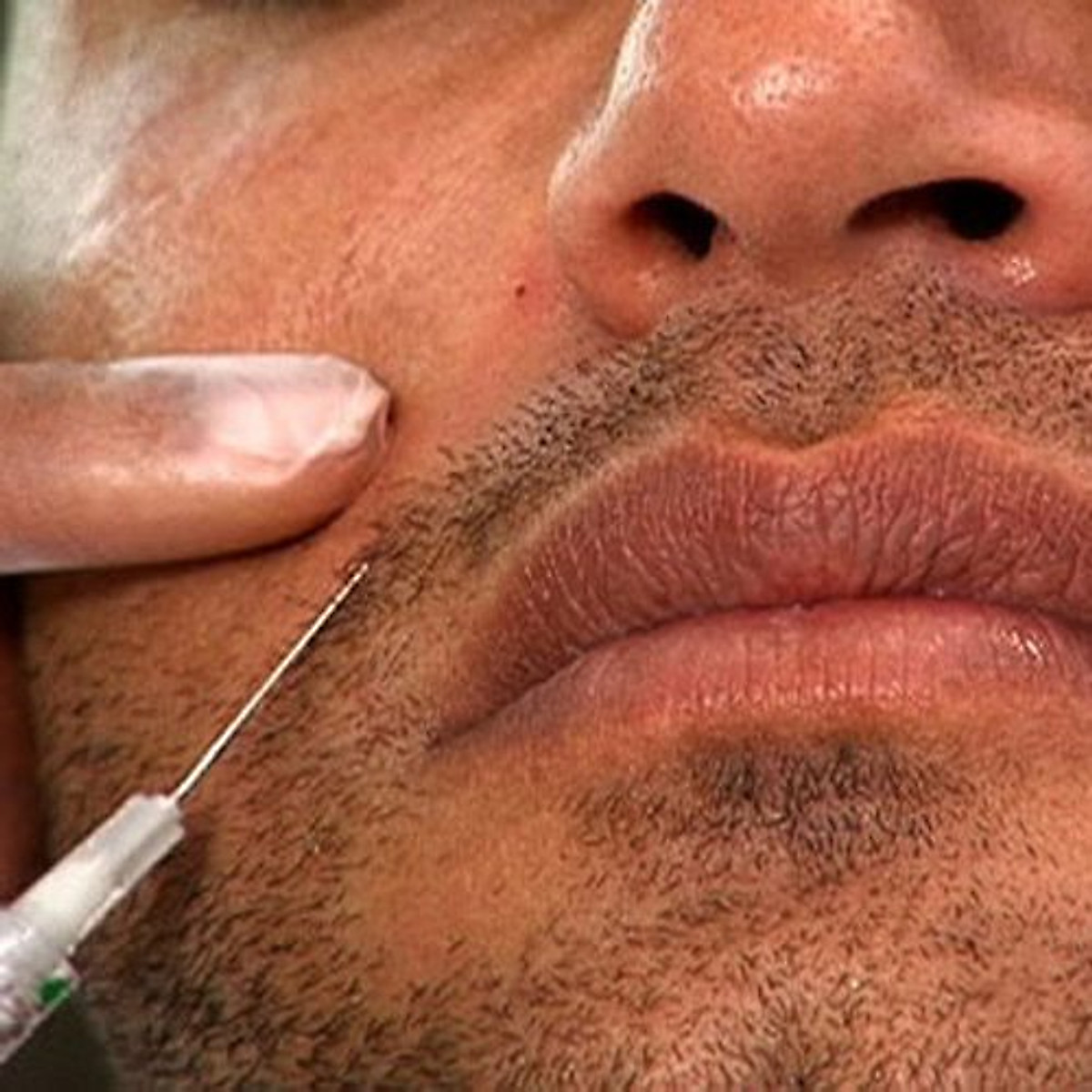 The Complete Guide to Dermal Filler Injections - Learn How To Inject Juvederm - Learn How To Inject Radiesse - This Advanced Radiesse Training Video / Juvederm Training Video Shows Injection Techniques for Medical Aesthetics Training