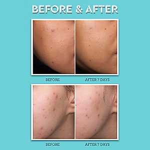 Bliss Clear Genius Acne Spot Treatment – Maximum Strength 2% Salicylic Acid Shrinks Blemishes – Clean, Vegan, Cruelty-Free, 0.5 Fl Oz