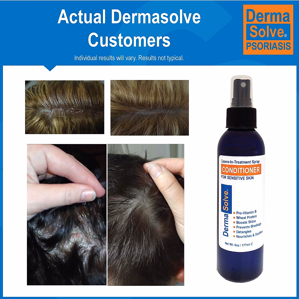 Dermasolve Psoriasis Leave-In-Treatment and Styling Spray Conditioner for Seborrheic Dermatitis, Sensitive Skin, Detangle, De-Flake, Soothing Anti Dandruff, Dry Scalp Repair for Damaged Hair