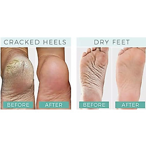 Peach Foot Peel Mask - Repair Cracked Heels, Remove Dead Skin. Makes Your Feet soft And Beautiful