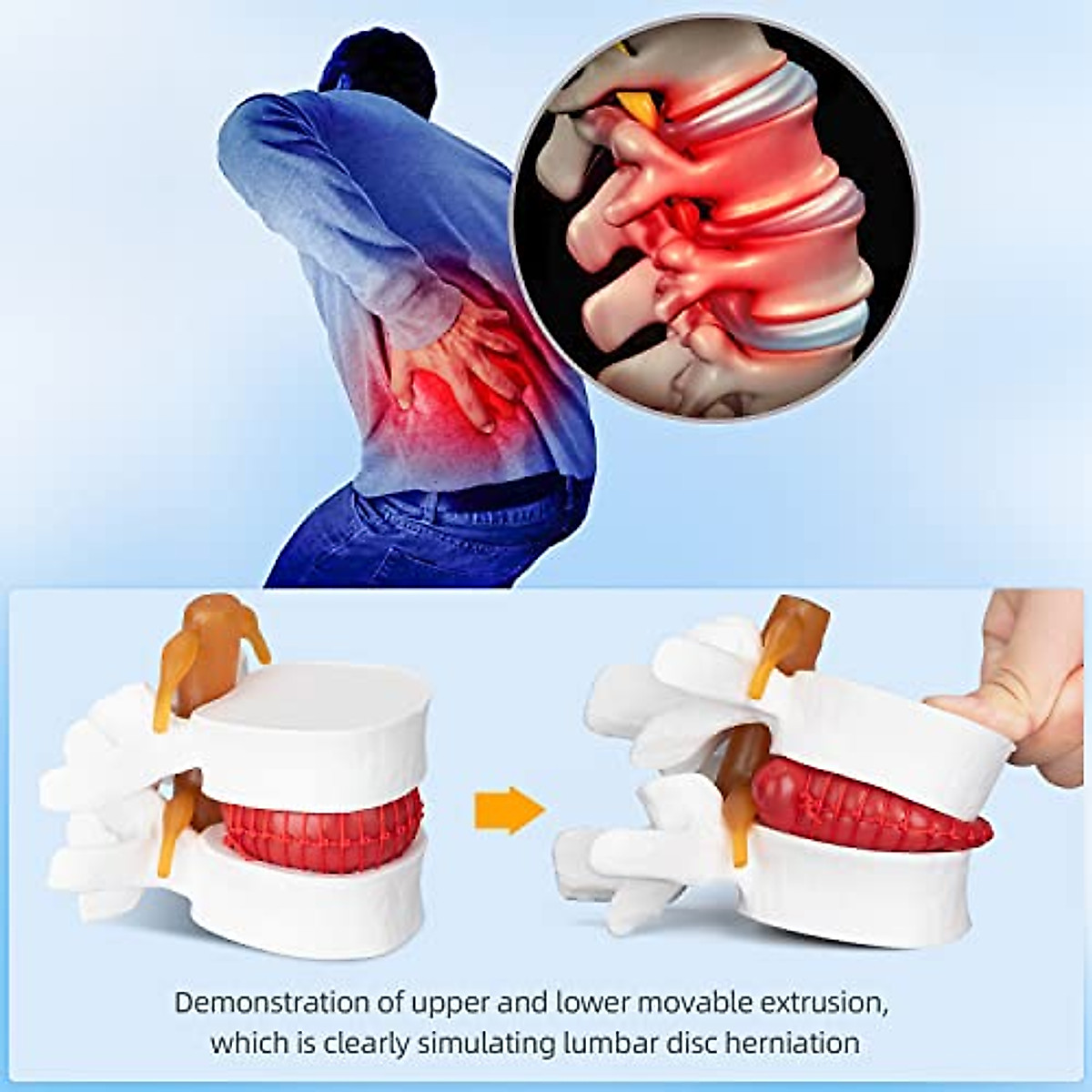 faruijie Disc Herniation Model - 1.5X Lumbar Herniated Disc Model Vertebral Spine Anatomical Medical Model