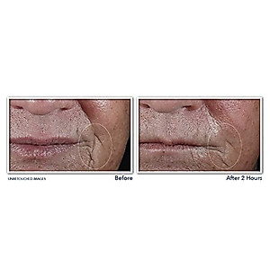 RoC Retinol Correxion Deep Wrinkle Non-Invasive Targeted Patches with Hyaluronic Acid + Firming Peptides for Forehead and Between Eyes, 3 Pouches of 2 Patches Each + 1 Packette of Eye Cream