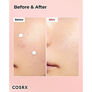 COSRX Acne Blemish Spot Drying Lotion 1.01 fl. oz / 30ml Dry and Reduce Blemish Spot, Pimple, Whitehead, Spot Treatment