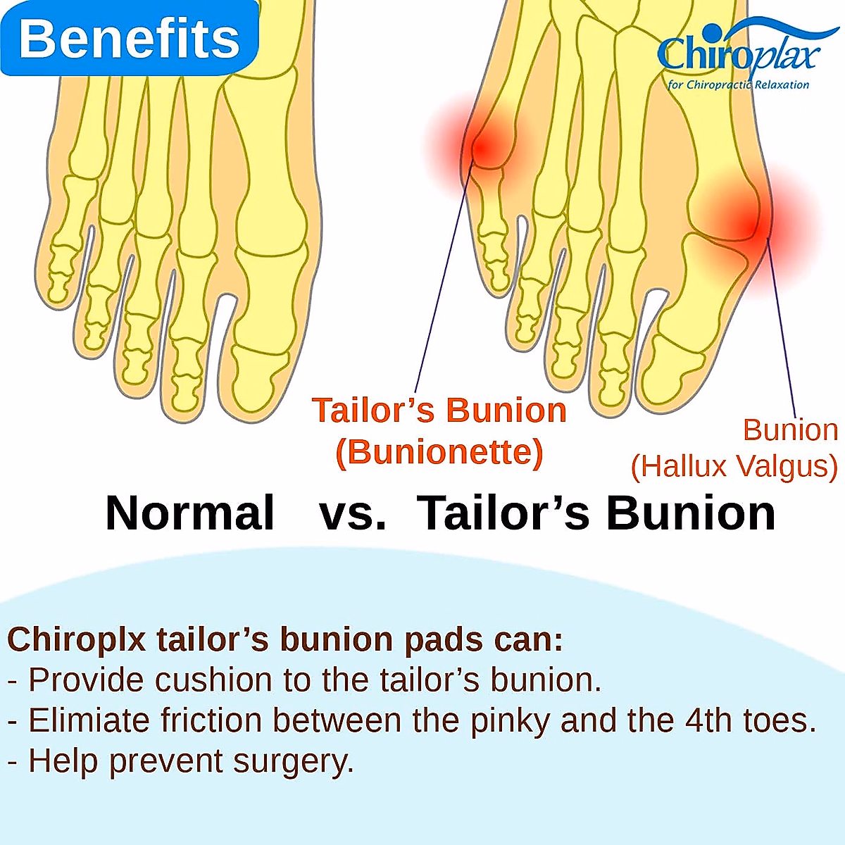 Chiroplax Tailor's Bunion Corrector Pads Bunionette Pain Relief Pinky Little Toe Straightener Separator Cushion Splint Protector Shield Spacer Cover Guard (4 Pads, Shims -Small)