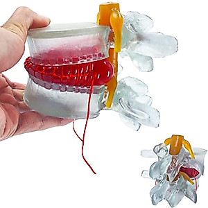DenFactory Human 1.5 Times Life-Size Transparent Lumbar Disc Herniation Spine Model for Teaching and Learning