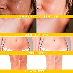 Ashania Dark Spot Remover For Body Cream, Dark Armpit Remover, Neck, Elbows, Armpit, Knees, Bikini Areas, Inner Thighs, Sun Spot and Private Areas